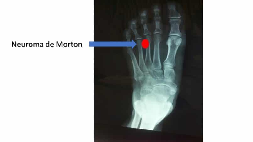 ¿Qué es el Neuroma de Morton? - Clínica Fuensalud