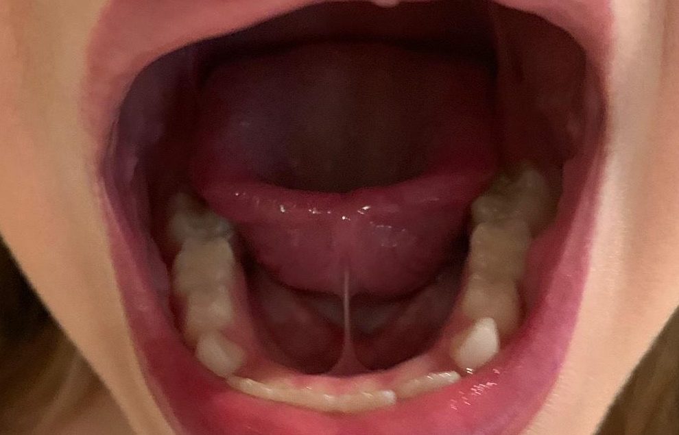 Frenillo lingual corto ¿qué puedo hacer? - Clínica Fuensalud