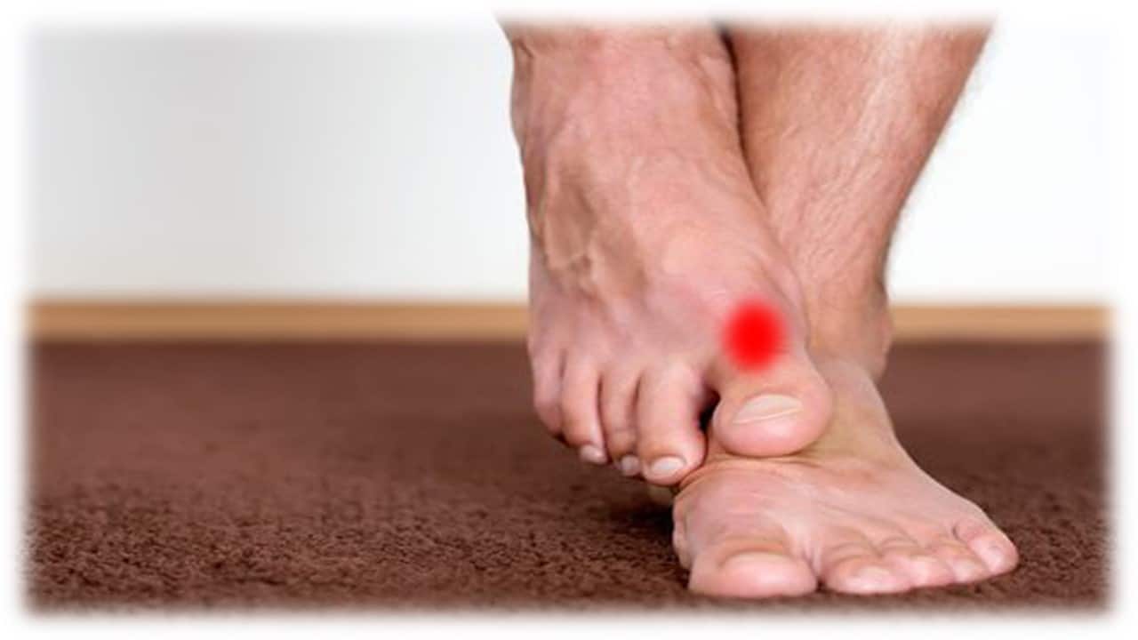 10 Recomendaciones para evitar los Ataques de Gota - Clínica Fuensalud