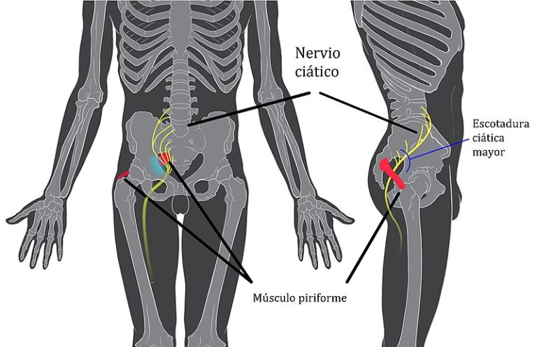 Ciática tratada con 🟢 Fisioterapia - Clínica Fuensalud