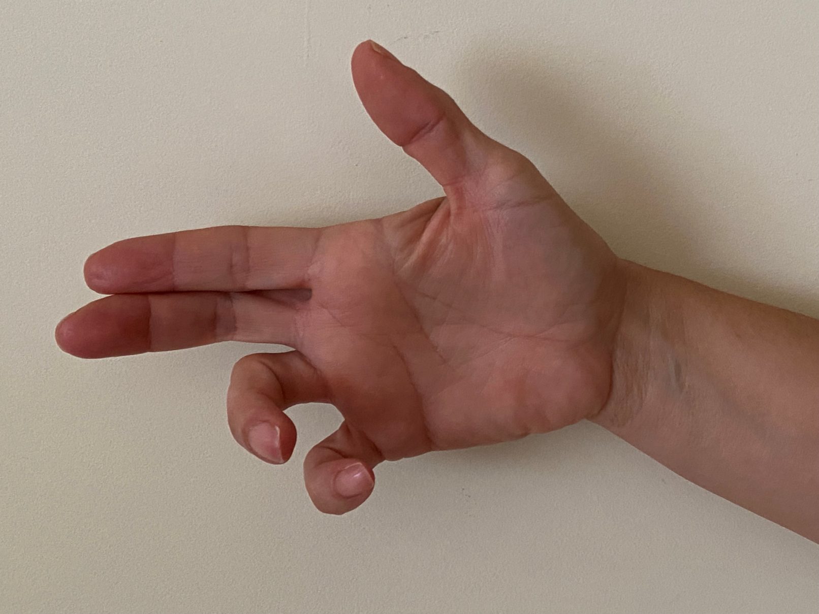 Enfermedad de Dupuytren y su tratamiento - Clínica Fuensalud