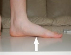 Luxación de la Rótula tratada con Fisioterapia - Clínica Fuensalud