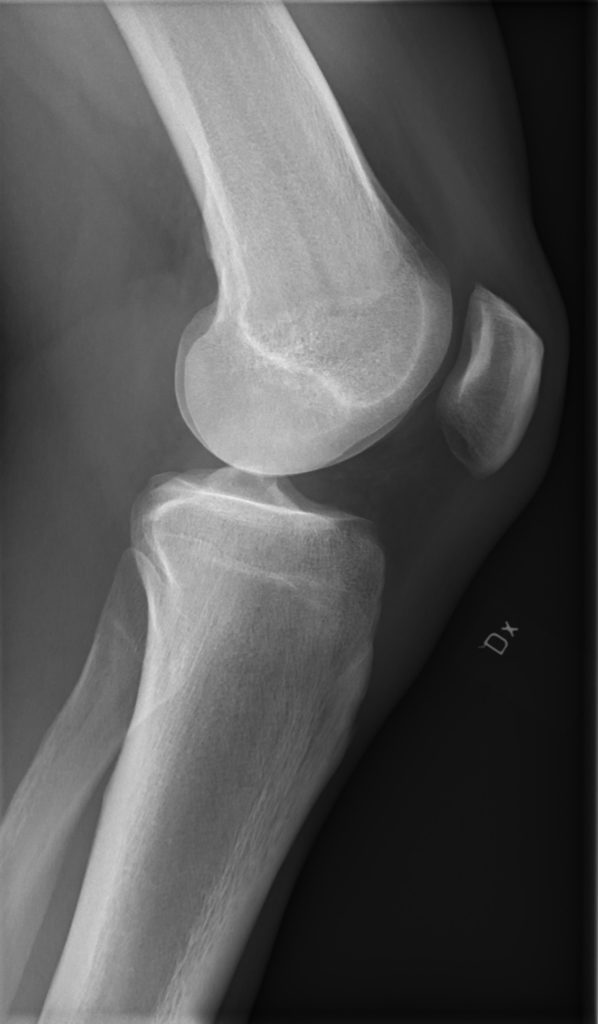 Luxación de la Rótula tratada con Fisioterapia - Clínica Fuensalud