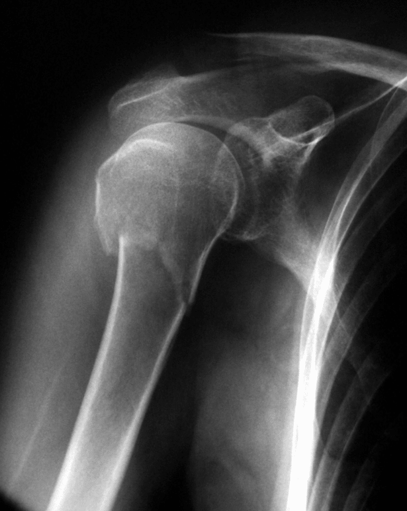 Fractura de hombro y tratamiento - Clínica Fuensalud