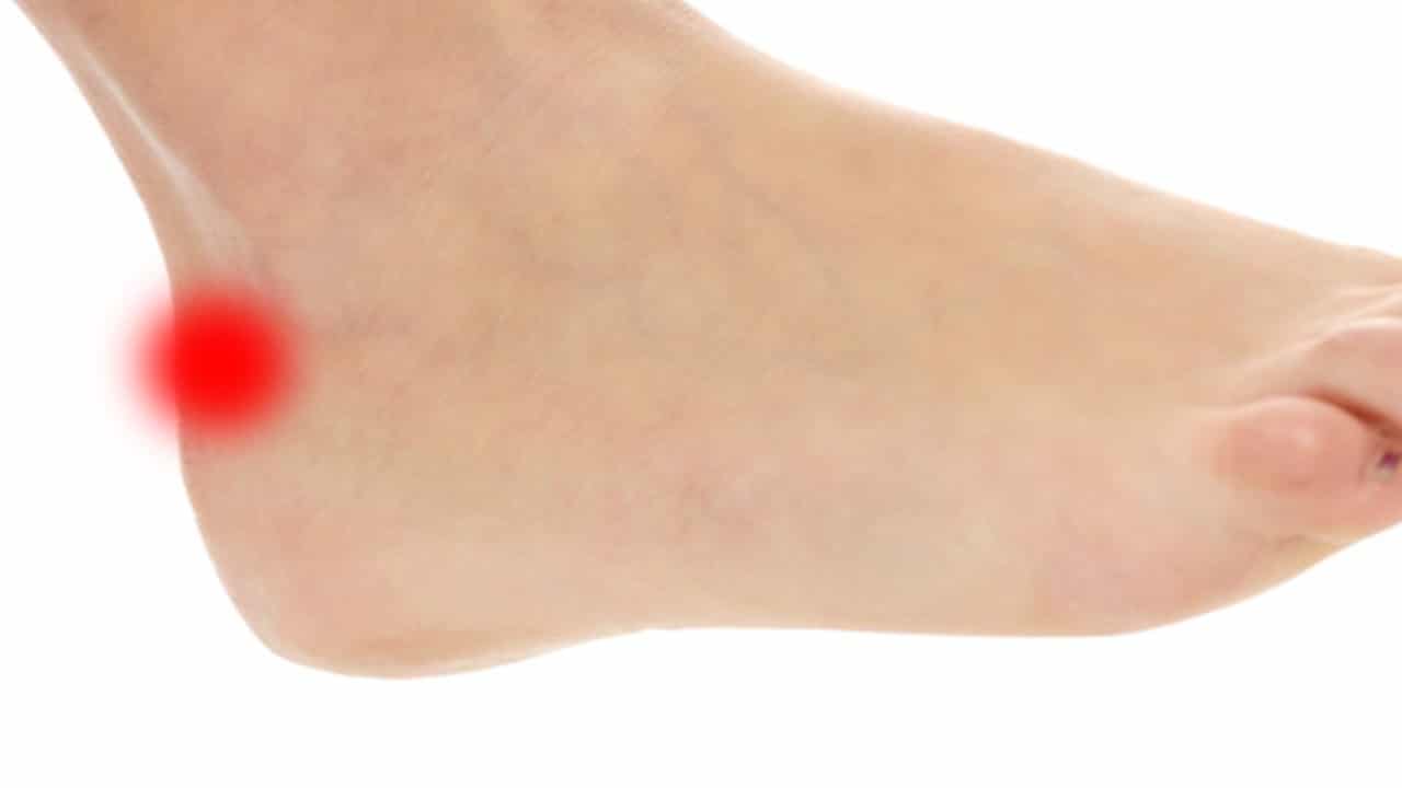 Enfermedad de Haglund - Clínica Fuensalud