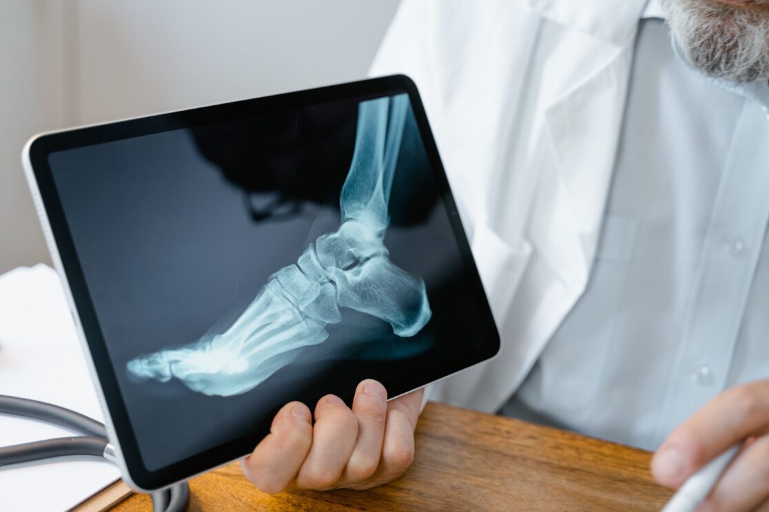 Pie reumático y tratamiento podológico. - Clínica Fuensalud